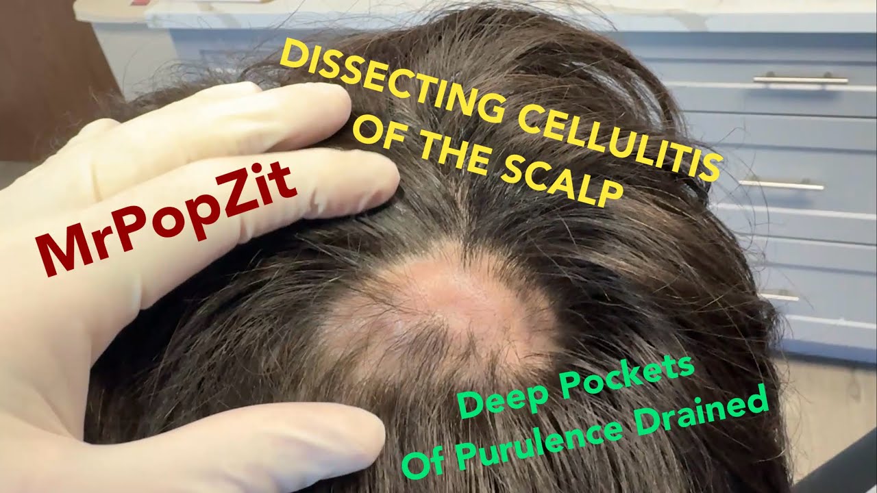 MrPopZit aka Greg Lynch Derm PA | PreserveTube